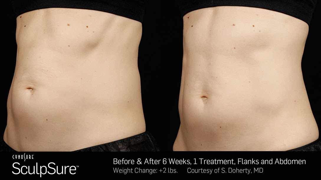 SculpSure - Non-Invasive Body Sculpting for Your Problem Areas!